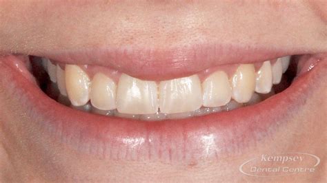 Advanced Lightwire Functional Alf Appliance Kempsey Orthodontic Clinic