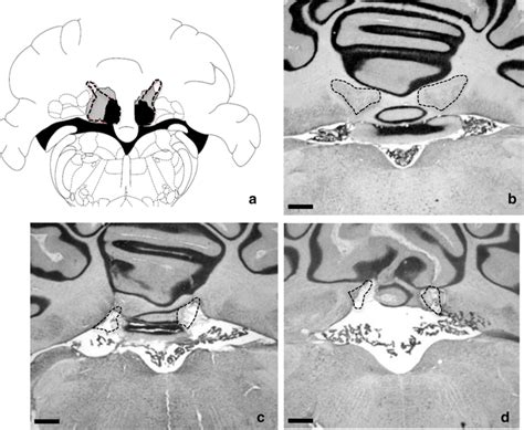 Lesion Sizes In The Fastigial Nucleus After Bilateral Download
