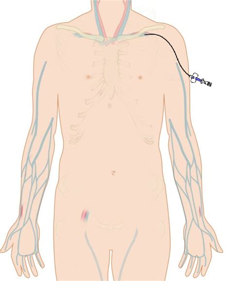 Catheter In Subclavian Vein Anatomytool
