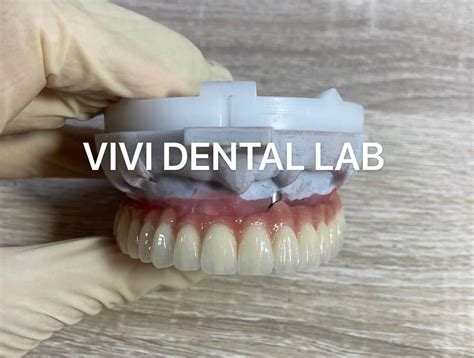 Screw Implant Digital Dental Crowns And Bridge Scheftner Ivoclar