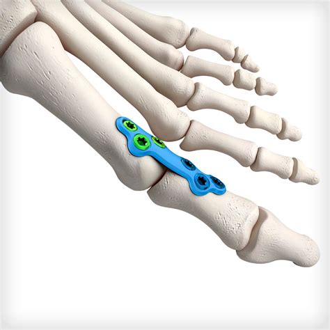Mtp Fusion Plates Unite Foot And Ankle