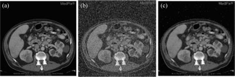 Denoising Results Of Proposed Mtni Sdsnr Technique For Ct Scan Image