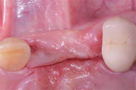 Lateral Block Augmentation In The Posterior Maxilla With Cancellous