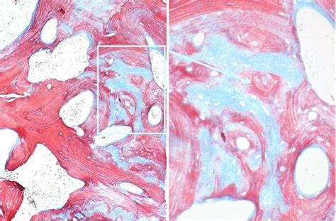 Areas Of Unformed Osteoid Masson Stain ×100 And ×200 Download Scientific Diagram