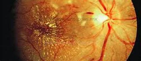 Hypertensive Retinopathy Dr Reichmann