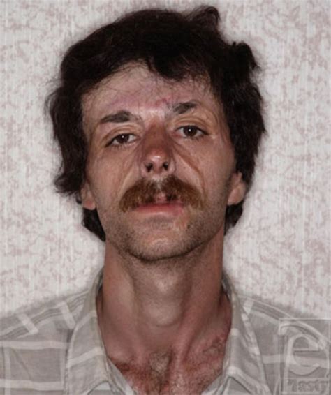 The End Result Of Scalp And Forehead Reconstruction Download Scientific Diagram