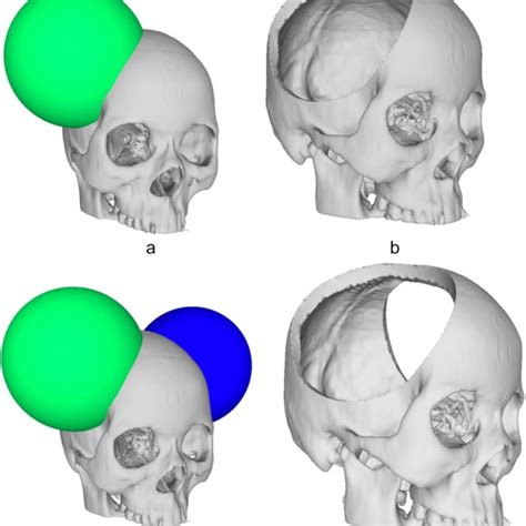 Proposed Workflow For Reconstruction Of Cranial Defects Download Scientific Diagram