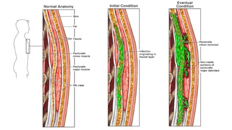 Necrotizing Fasciitis Internet Book Of Msk Ultrasound