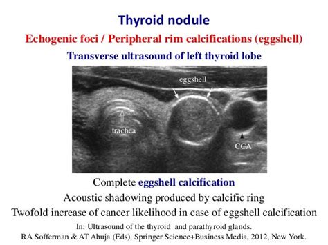 Ultrasound Of Thyroid Nodules