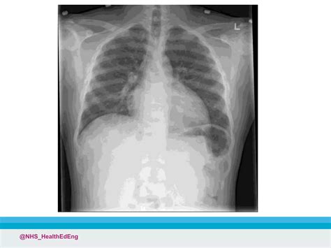 Abcde Cxr Final Version Pptx