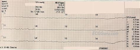 Trifascicular Block Ecg Guru Instructor Resources