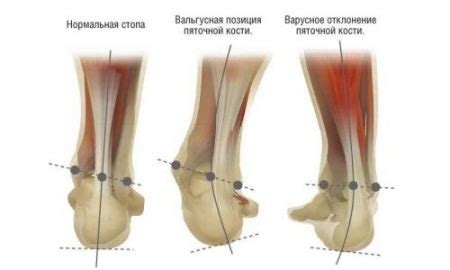 Ортопедическая обувь для детей и женщин для лечения вальгусной ...