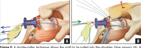 Figure 3 From Superior Capsular Reconstruction Semantic Scholar