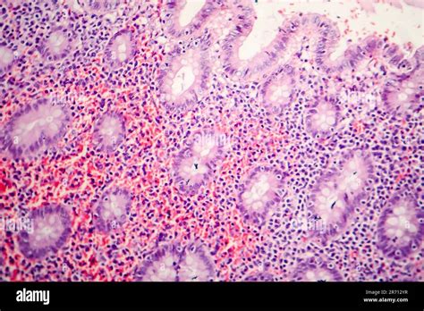 Histopathology Of Chronic Appendicitis Light Micrograph Photo Under