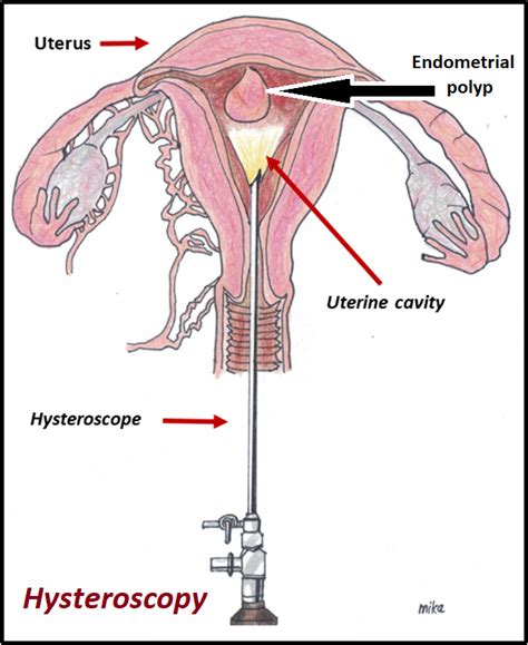 Uterine Polyps Endometrial Polyp Causes Symptoms Mayo Clinic Q And A