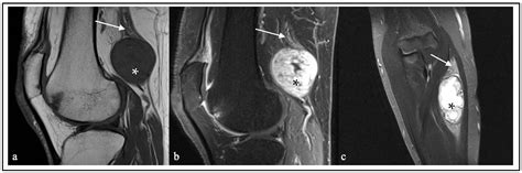 Collection Of Rare Peripheral Nerve Tumors—insights From The German