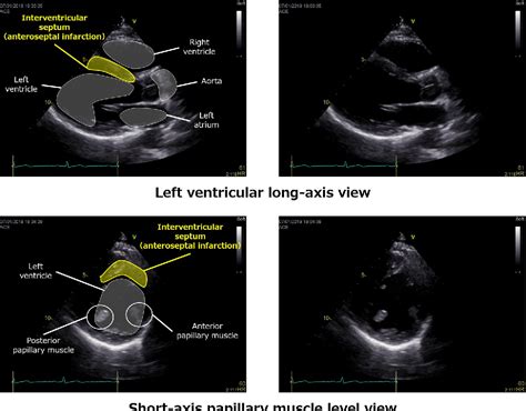 Figure 2 From Automated Detection Scheme For Acute Myocardial Infarction Using Convolutional