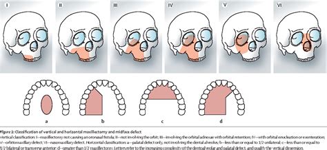 Figure 1 From Reconstruction Of The Maxilla And Midface Introducing A New Classification
