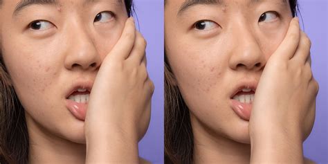 Spironolactone For Hormonal Acne How It Works Benefits Side Effects