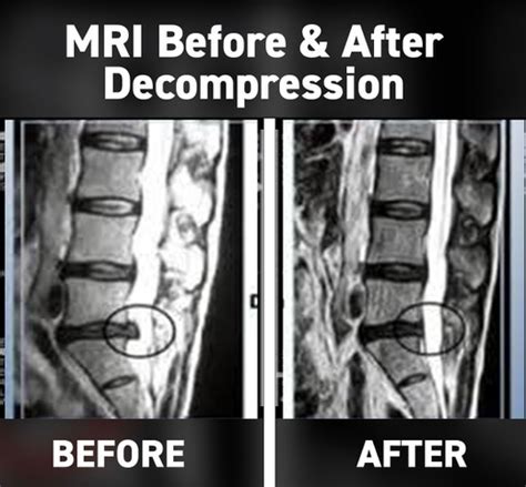 Spinal Decompression In Tamarac Fl Dr Bo Brooks