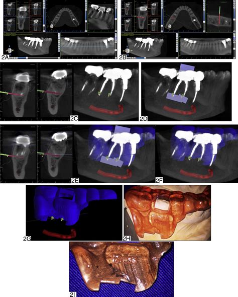 Techniques In Endodontic Microsurgery At April Newton Blog