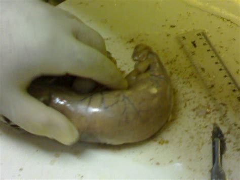 Huge Mucocele Of The Appendix Dr Raad Al Saffar