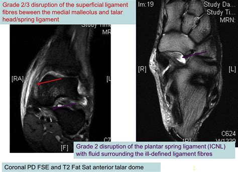 Tibialis Posterior Tendon And Deltoid And Spring Ligament Injuries In