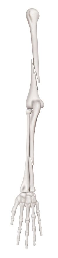 척 골 및 상 완 골 골절 또는 깨진 팔 완료 난민 골절 유형 앞쪽 보기3d 의료 생물 의학 그림건강 관리흰색 배경에 고립 가락뼈에 대한 스톡 사진 및 기타 이미지 Istock