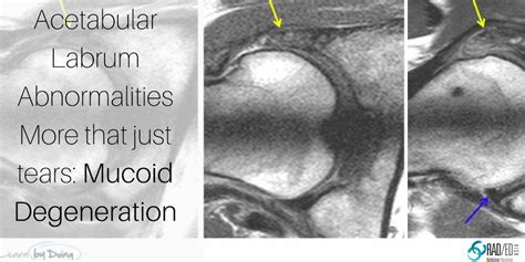 Labral Tear Of Hip