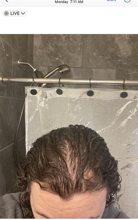 Progress On Hair Growth After A Year And 3 Months On Finasteride R