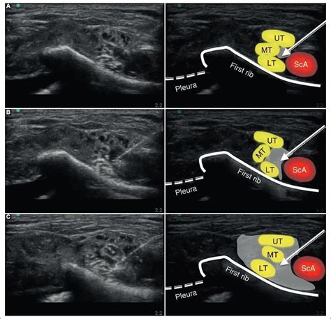 Ultrasoundguided Supraclavicular Brachial Plexus Block