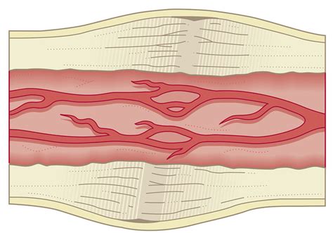 动脉粥样硬化可以逆转，一招可将血管壁清理干净，软化血管溶血栓 逆转 血管壁 硬化 新浪新闻