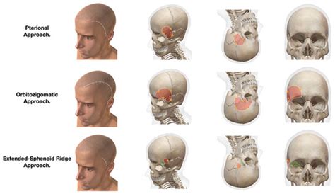 Sphenoid Sinus Tumor Removal Surgery Oqwcdg