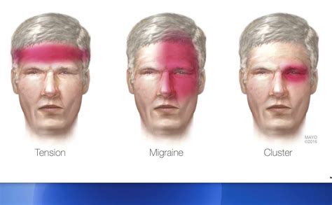 Medical Podcast “tension Headache” Can Be Episodic Or Chronic The Bmj