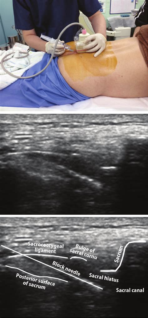 Ultrasound Probe Positioning And Ultrasound Images Obtained During Download Scientific Diagram