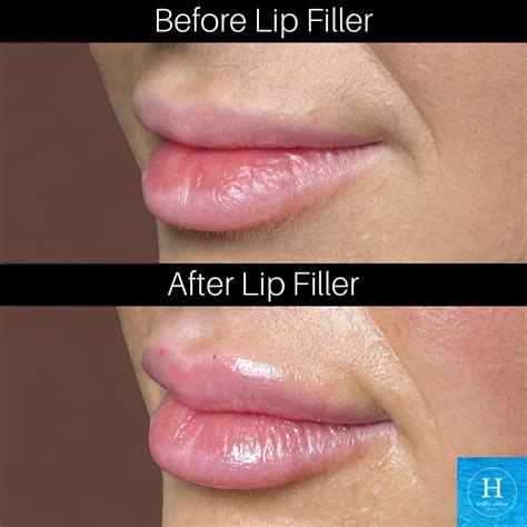 Lip Injections Before And After