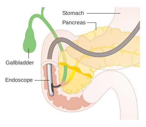 内窥镜逆行胰胆管造影 Ercp 知乎