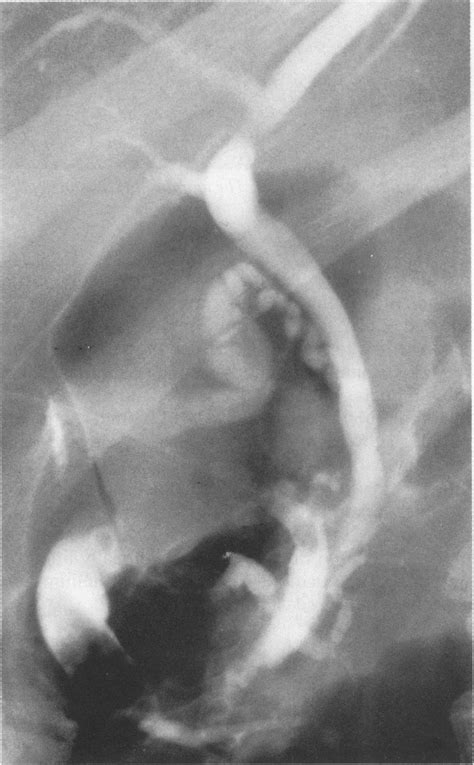 Film Of Result Of Two Separate Injections At Major Papilla During Ercp Download Scientific