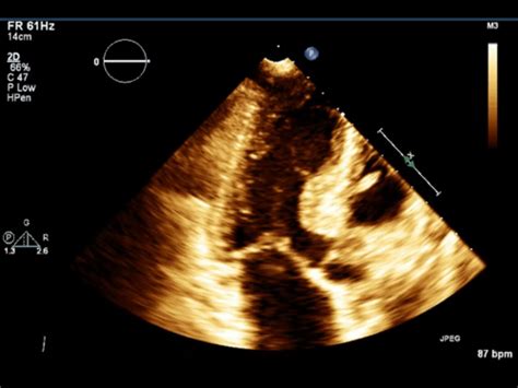 Basic Echo Hocm Hypertrophic Obstructive Cardiomyopathy And Hcm Or Non Obstructive