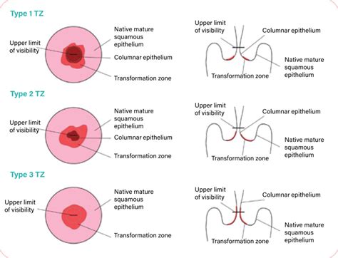Cervix Anatomy Transformation Zone