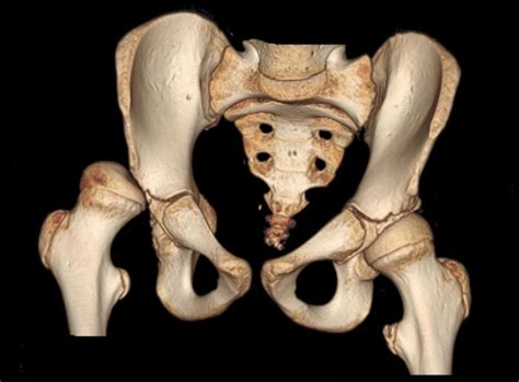 Spastic Hip Dislocation Clinical Tree