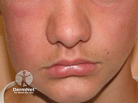 Plant Dermatitis Image