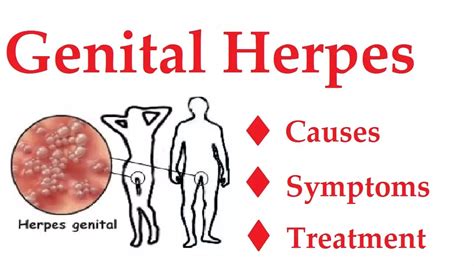 Sweetdoctor Genital Herpes Genital Herpes Is A Sexually Transmitted