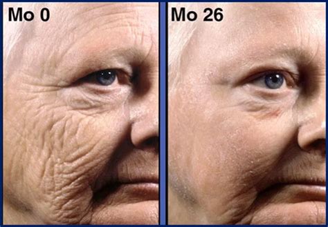 Retinol Before And After Pictures Of Skin Aging In 2025 Aging Skin