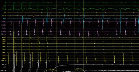 Entrainment From Ablation Catheter In Cavotricuspid Isthmus Indicating Download Scientific