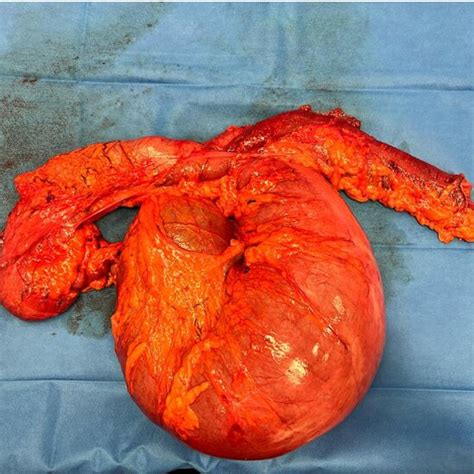Subtotal Colectomy Specimen Displayed In The Same Orientation As Was