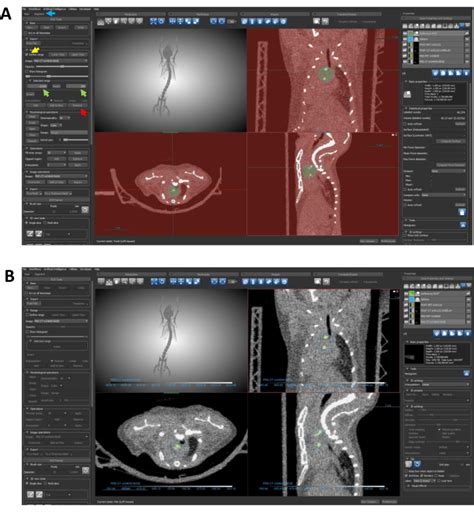 Novel Quantification Protocol For Cardiovascular Calcification
