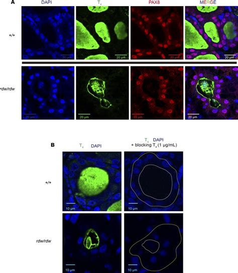 Jci Insight Thyroid Hormone Synthesis Continues Despite Biallelic Thyroglobulin Mutation With