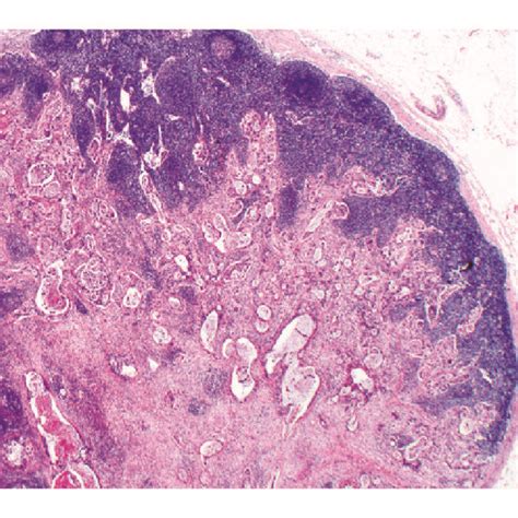 Hande Stained Sections Demonstrating Focal Chronic Active Colitis