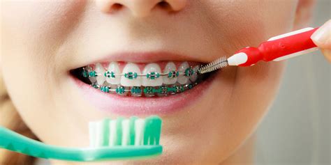 Patient Instructions Smith Orthodontics In Beavercreek Oh